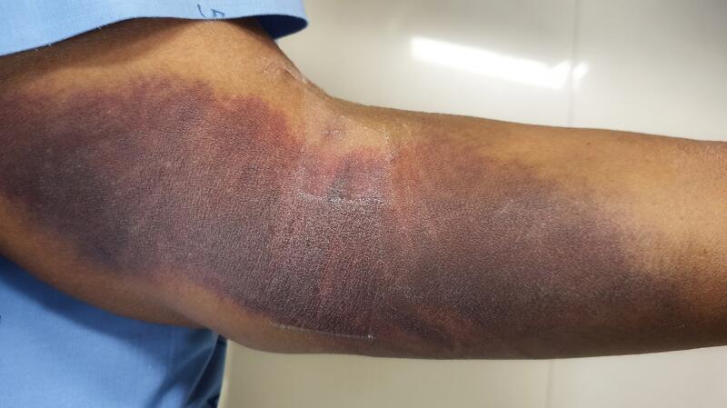 internal bleeding causes bruises