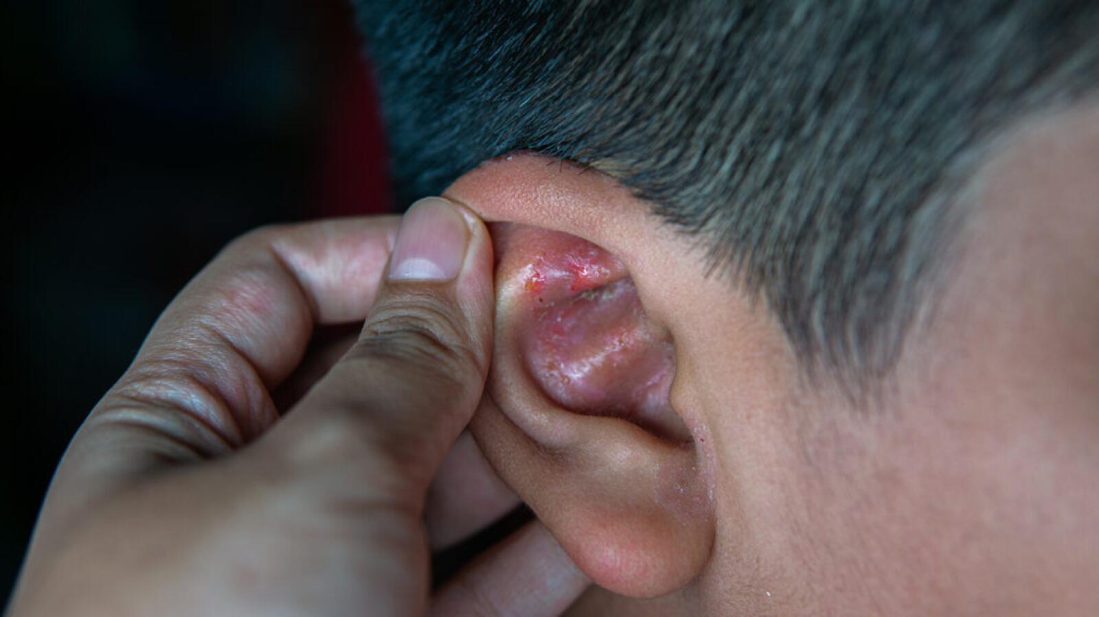 Ear Eczema Symptoms Causes And Treatments Ear Eczema Symptoms Causes And Treatments