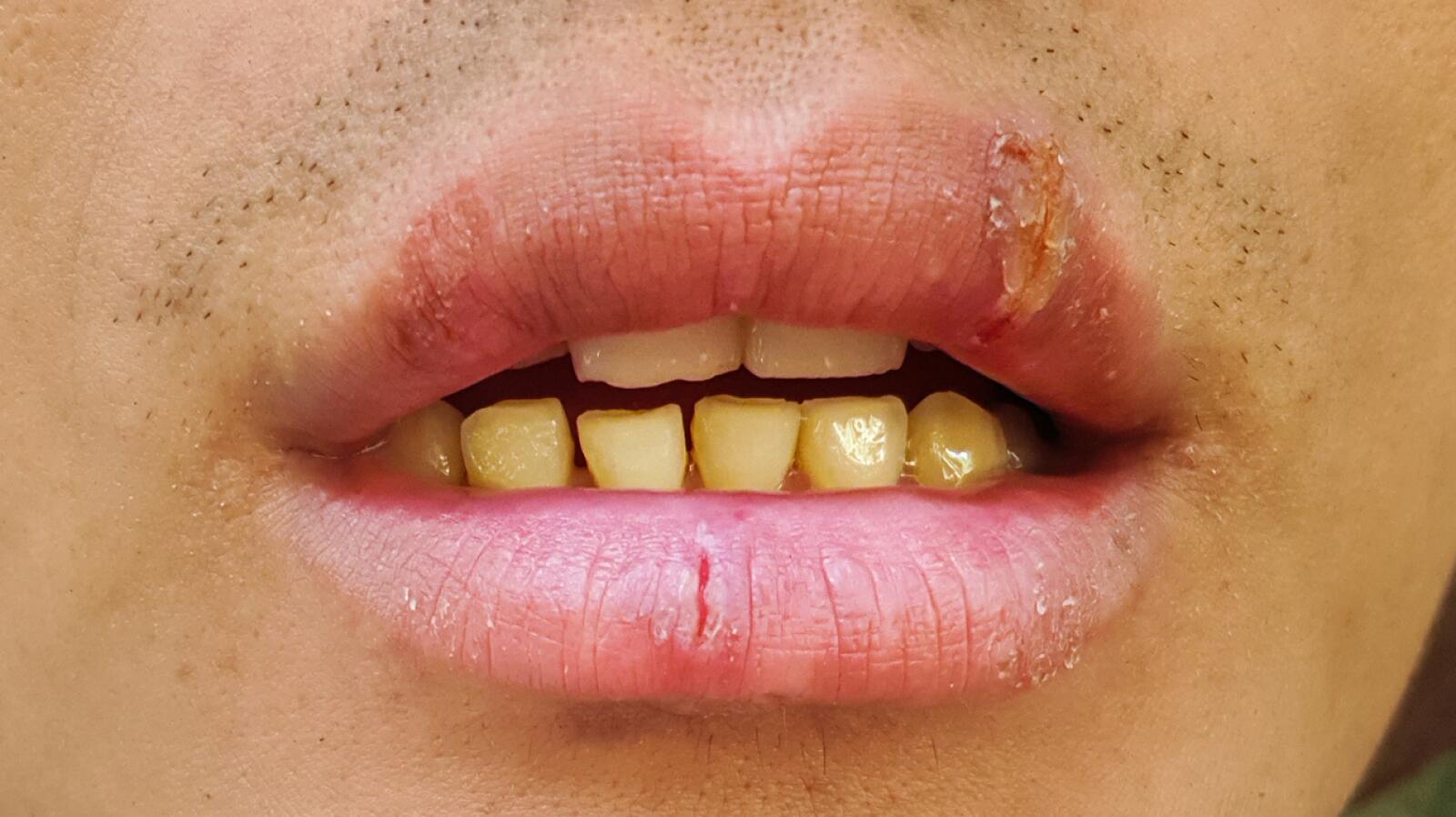 Chapped Lips Cheilitis Simplex Causes Treatments And Remedies