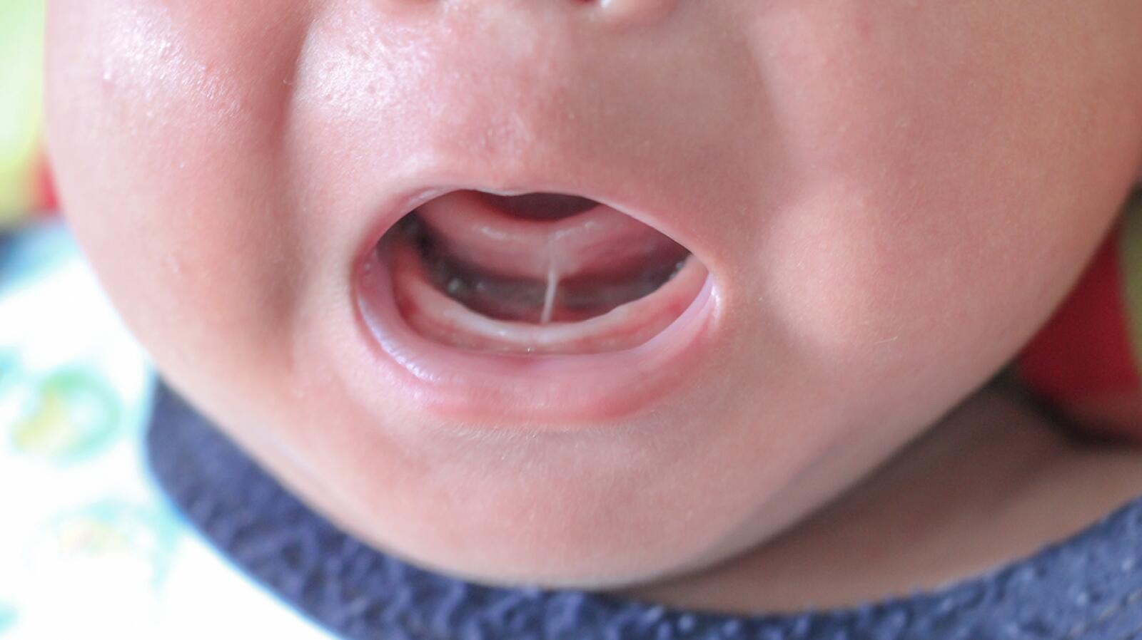 Tongue-Tie (Ankyloglossia): Pictures, Treatments, and More