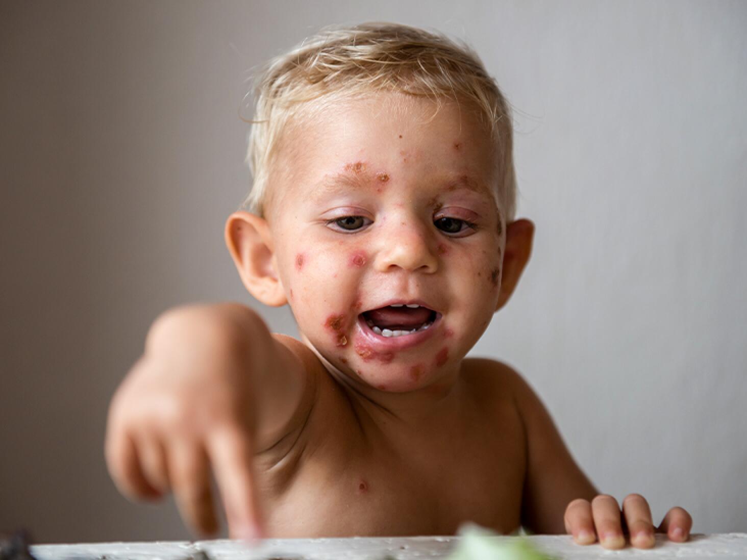 Rash On Face Causes Treatments Prevention And More rash-on-face-causes-treatments-prevention-and-more