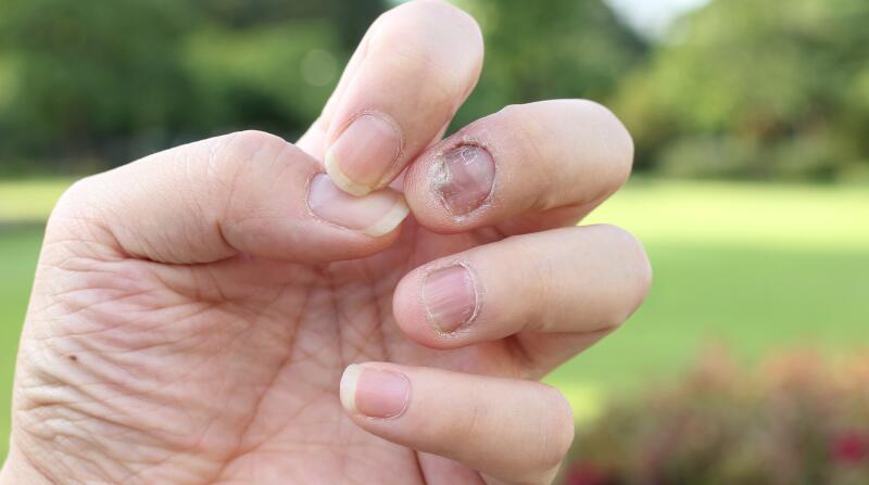 What Psoriasis Does to Your Body