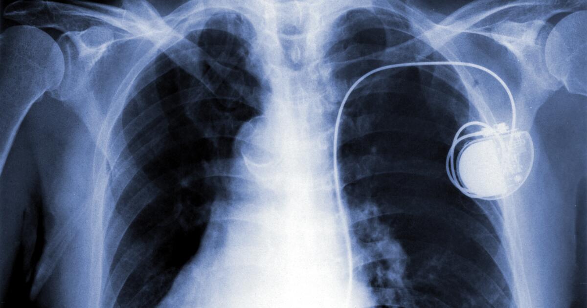8 Tips to Prepare for a Pacemaker Insertion | Pacemaker Precautions
