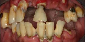 Mouth Cancer Pictures | What Oral Cancer Sores Look Like