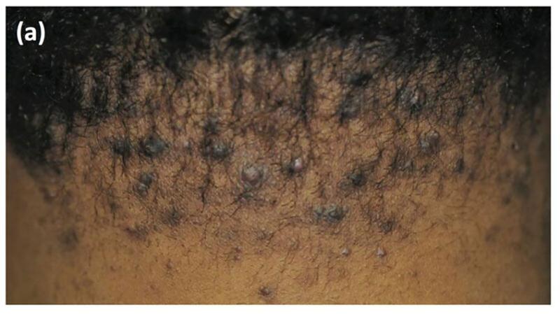 side head pimples