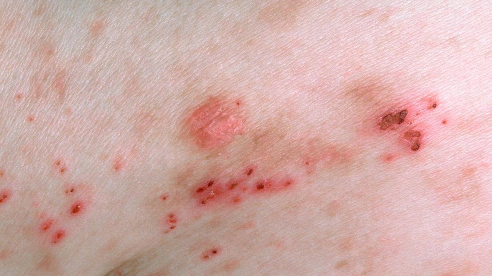Kidney Disease Rash: Pictures, Symptoms, Causes, and Treatments