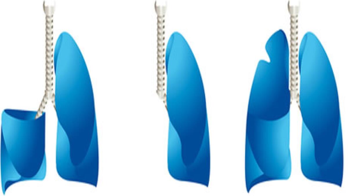 right upper lobectomy steps
