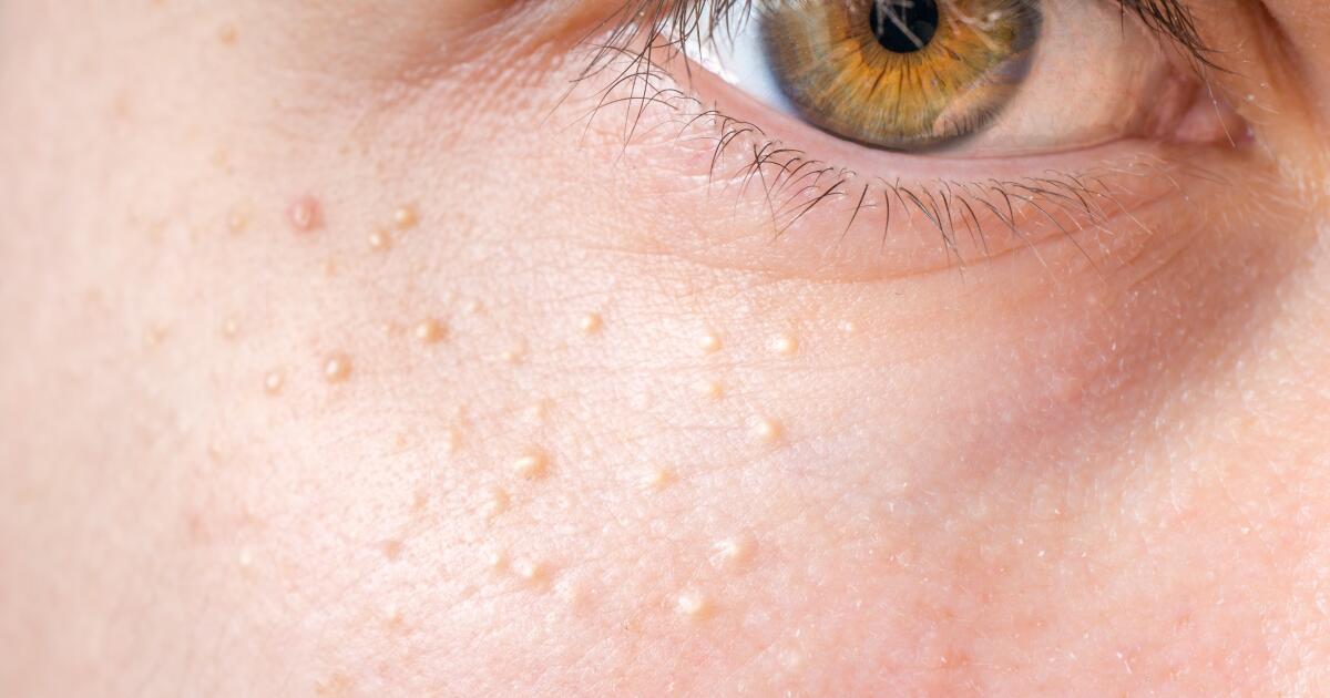 Milium Cyst (Milia): What It Is & How to Get Rid of It