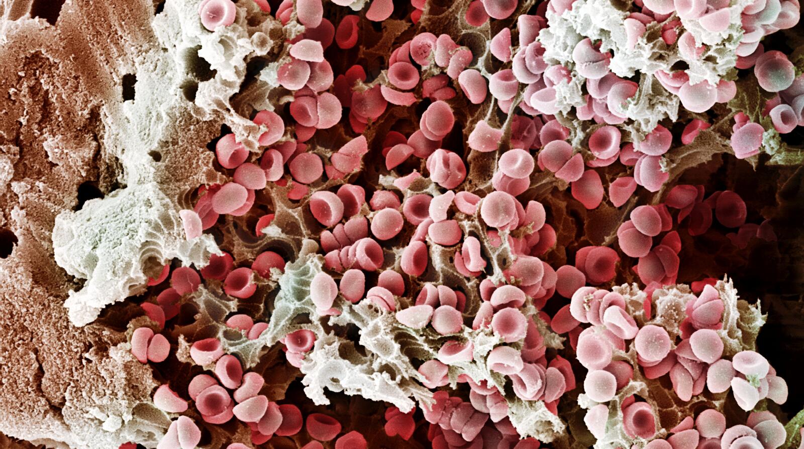 7 Rare Diseases That Affect the Blood