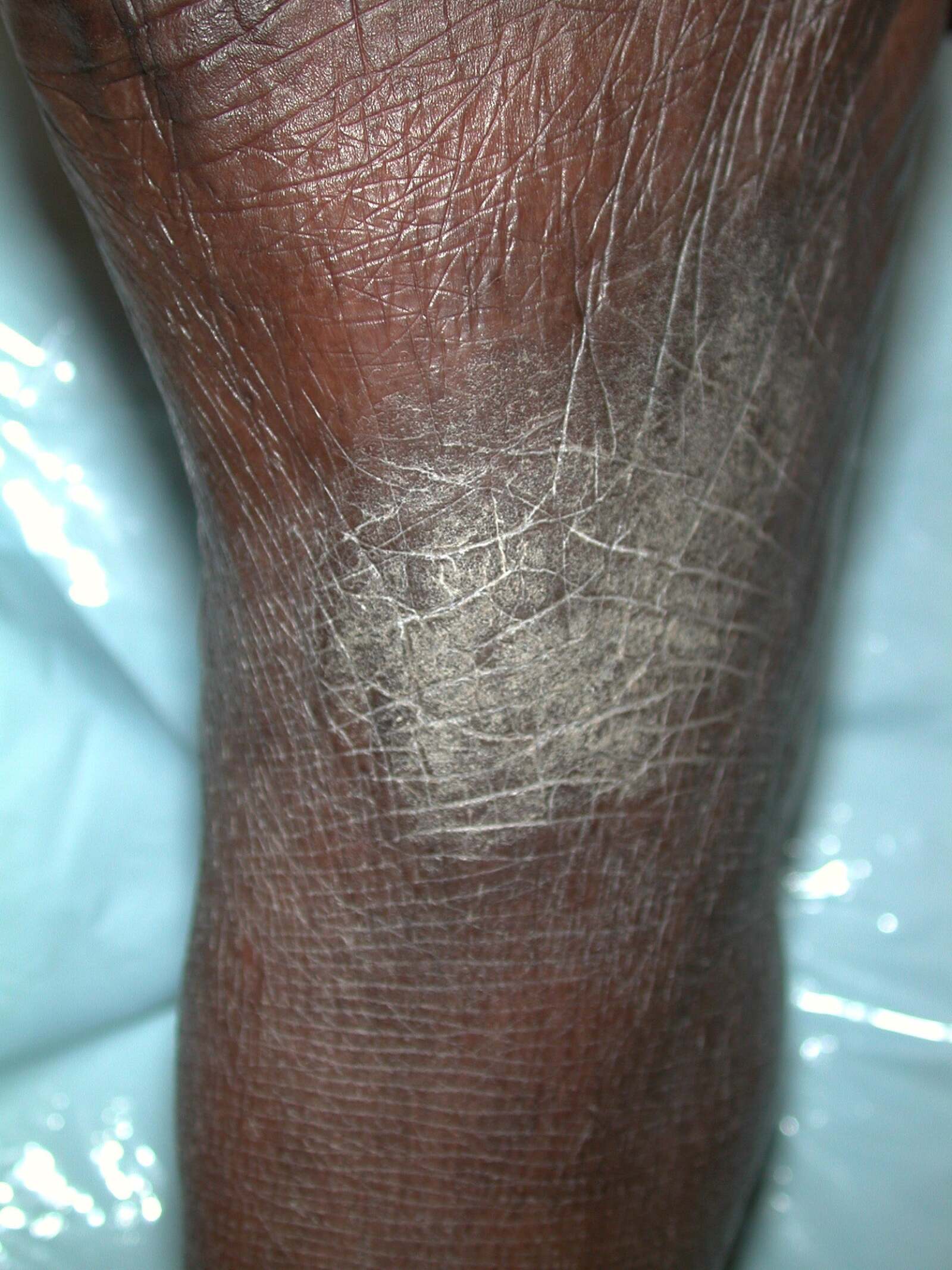 What Does Eczema Look Like? Pictures, Types, and More