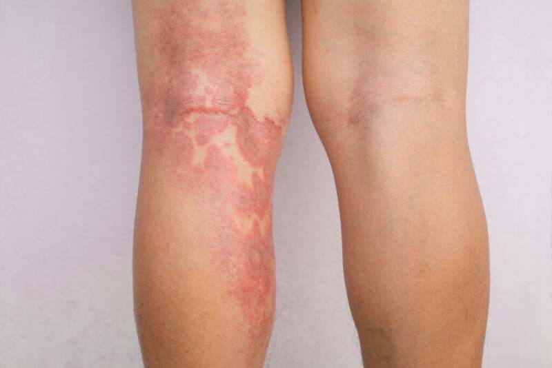 7 Types of Eczema: Symptoms, Causes, Treatment Options