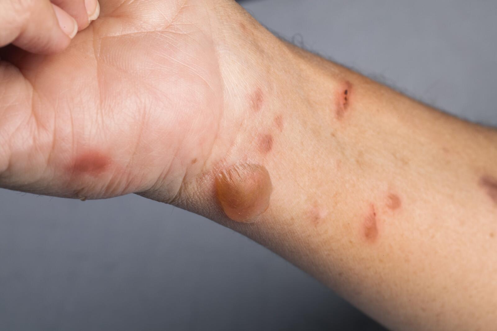 Second-Degree Burn: Causes, Symptoms, and Treatment