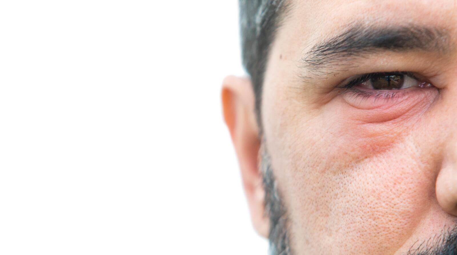 6 Things to Know About Blepharitis