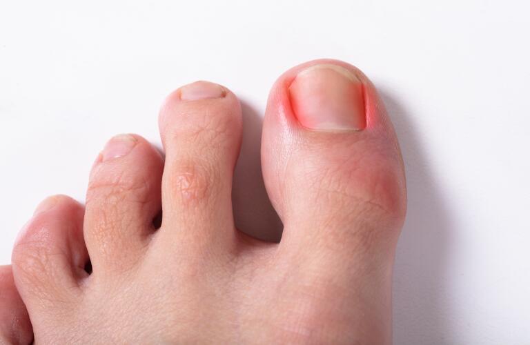 Toenail Problems: Fungus, Thickening & Yellow Toenails
