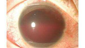 Hyphema: Symptoms, Causes, Treatment, and More
