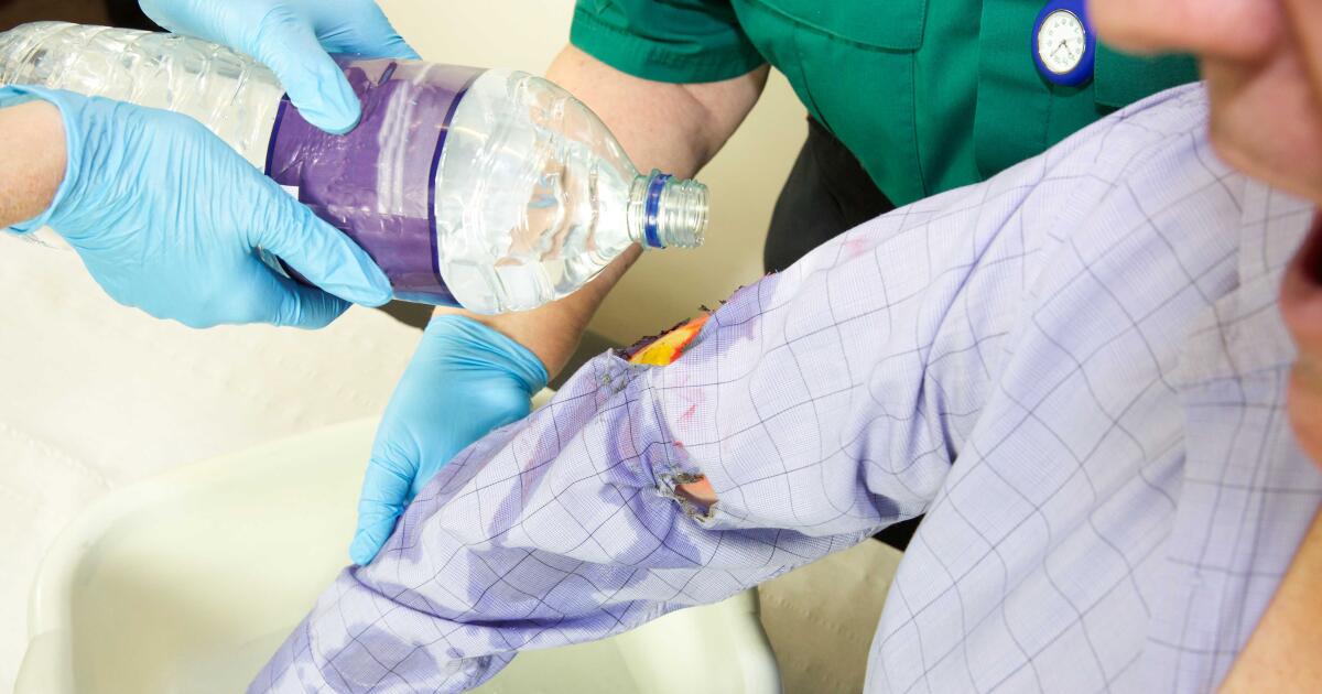 How to Treat Burns & Burn Blisters | Burns First Aid Treatment