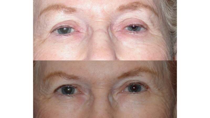 Ptosis: Causes, Symptoms, Diagnosis, and Treatments