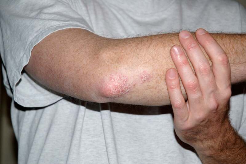 Psoriasis Vulgaris: Symptoms, Treatments, Outlook, and More