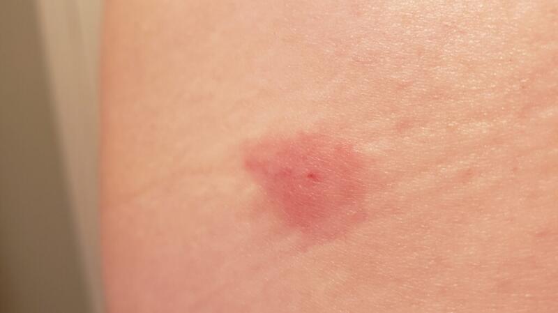 Deer Fly Bites On Humans