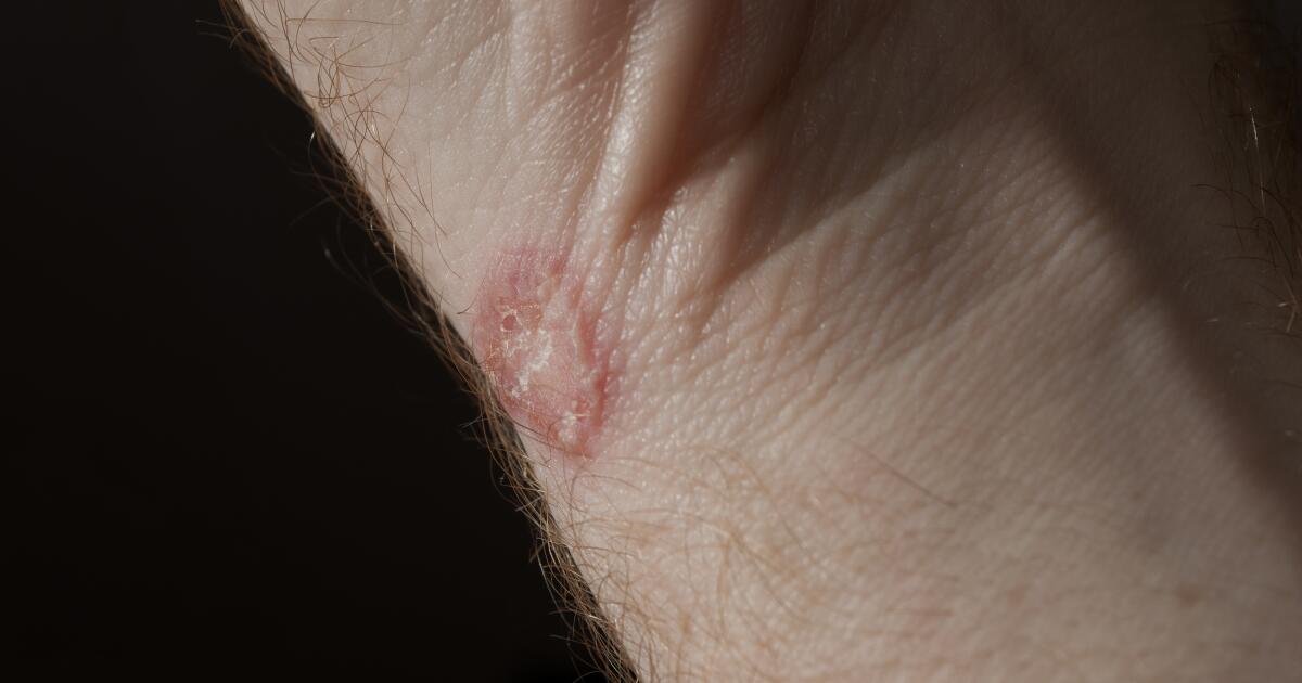 ringworm inside nose