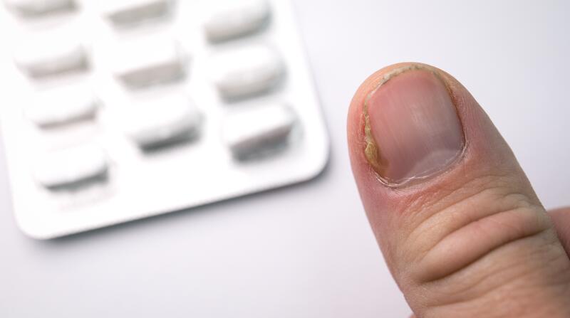 Ringworm Causes | 9 Things to Know About Ringworm