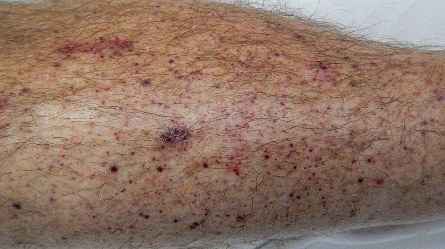 Red Spots on Skin - Causes and Treatment