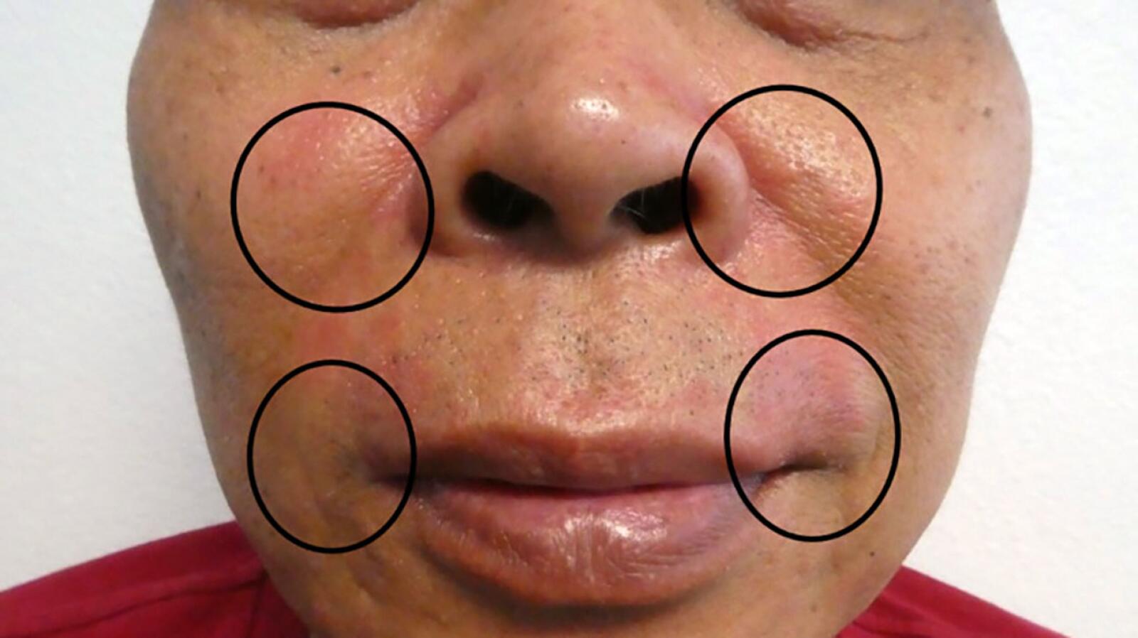 Perioral Dermatitis: Causes, Symptoms, Treatments, and More