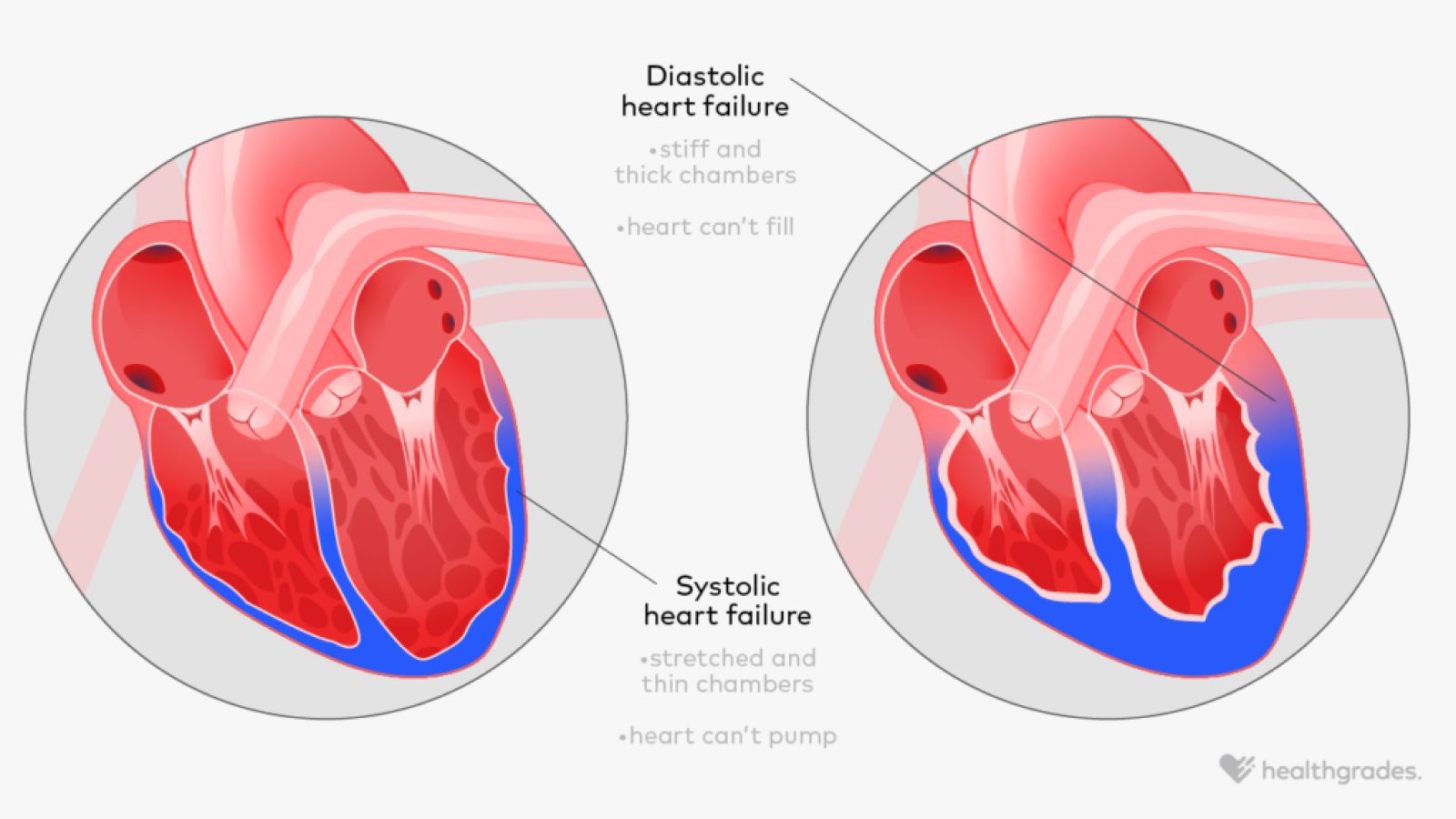 Systolic Vs. Diastolic Heart Failure: Symptoms, Causes, Treatments Systolic Vs. Diastolic Heart Failure: Symptoms, Causes, Treatments