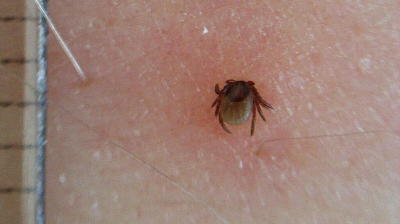 Bug Bite Pictures: Symptoms, Identification, Treatment, and More