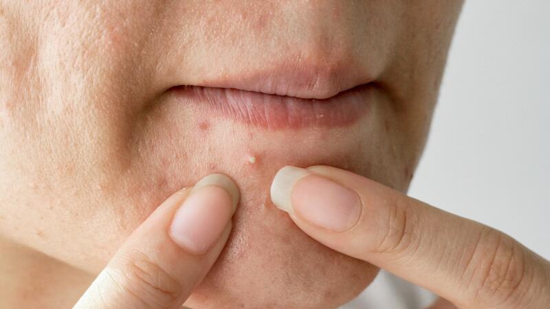 Sebum Plugs: Causes, Skin Health, and Safe Removal