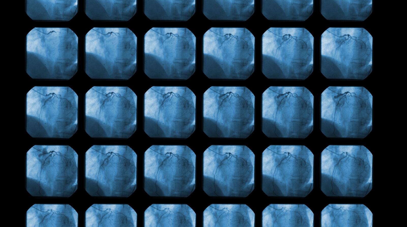 5 Conditions Diagnosed With Cardiac Catheterization