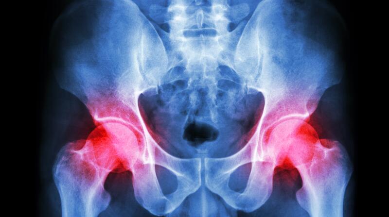 7 Things to Know About Bone Density Scans