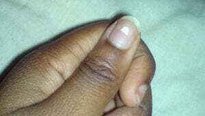 Kidney Disease and Nails: Possible Nail Symptoms