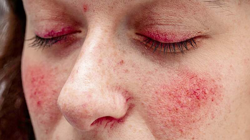 Lupus Rash vs. Rosacea: Symptoms, Causes, Treatments