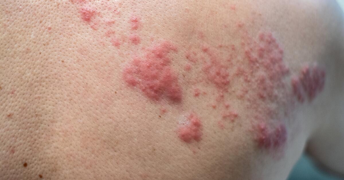 What Do Shingles Look Like? | Shingles Pictures