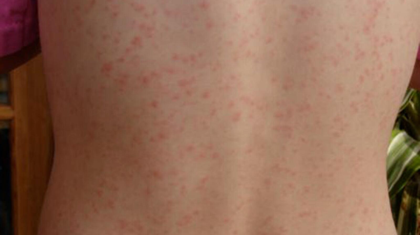 Red Spots on Skin - Causes and Treatment