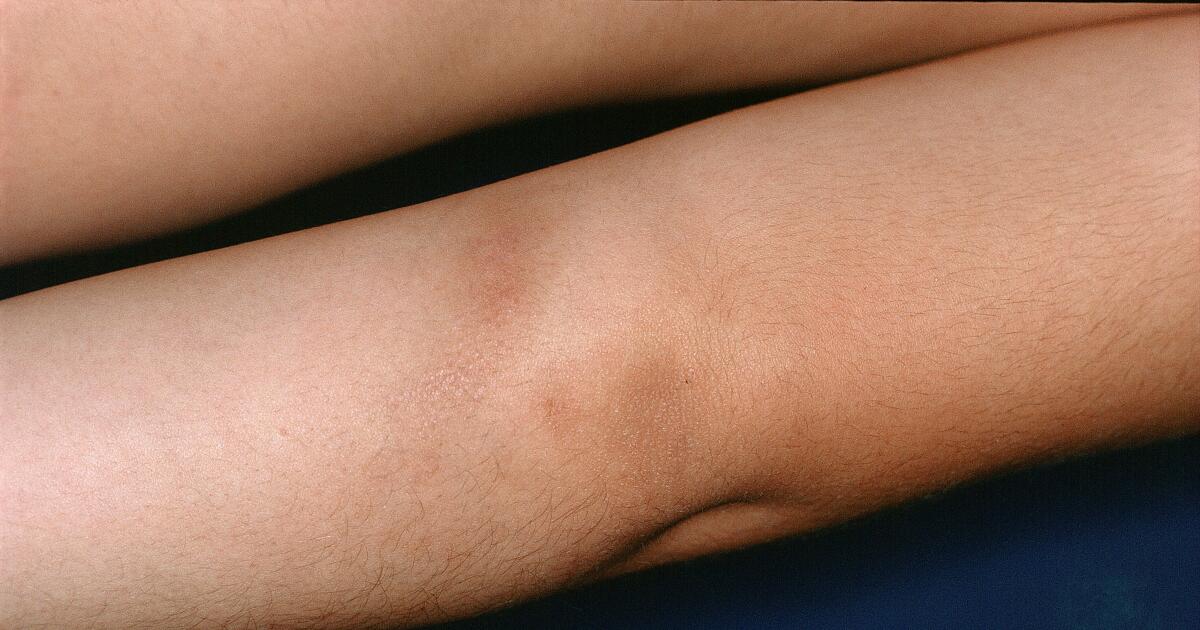 Morphea Facts | 5 Things to Know About Morphea