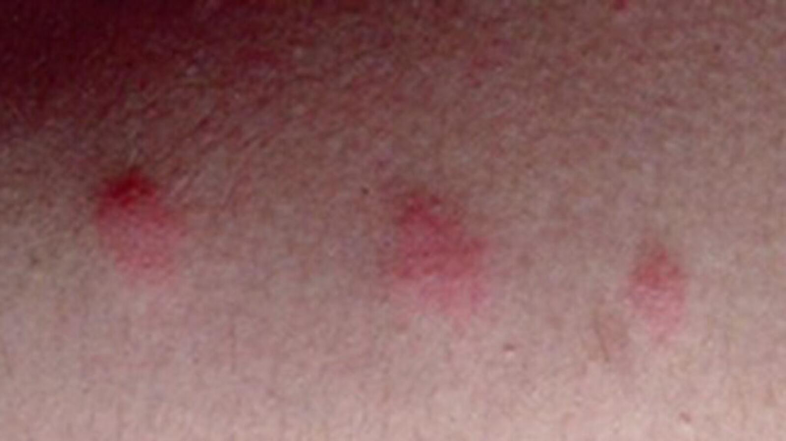 Bug Bite Pictures: Symptoms, Identification, Treatment, and More