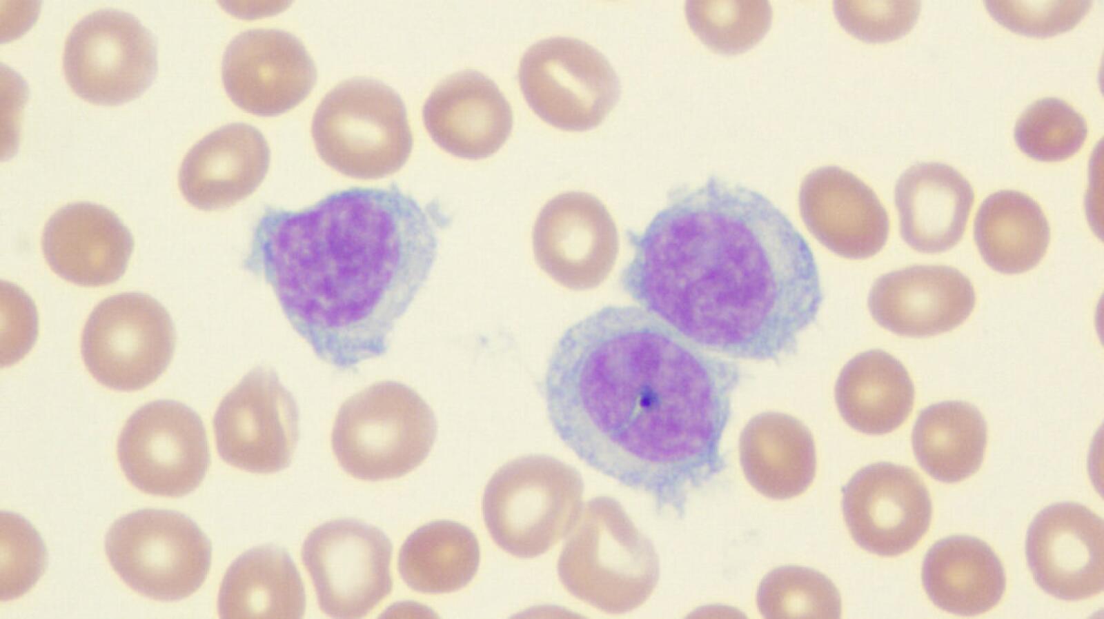 Hairy Cell Leukemia: Symptoms, Causes, Treatments Hairy Cell Leukemia: Symptoms, Causes, Treatments