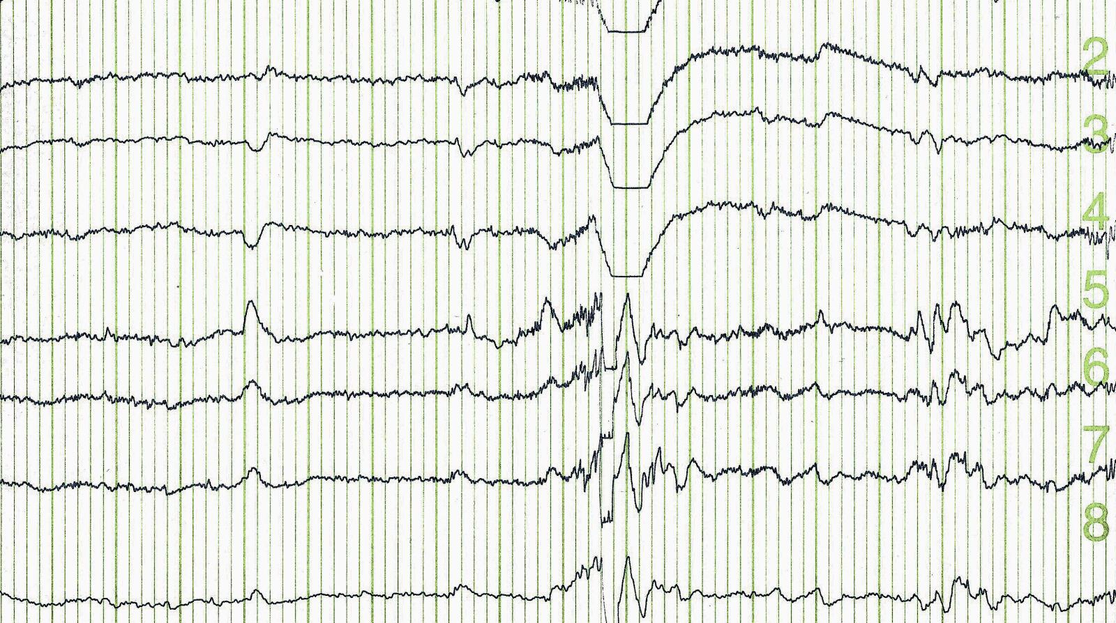 What to Know About EEGs | Electroencephalography for Neurological Symptoms