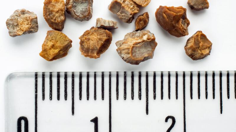 10 Things to Know About Kidney Stones