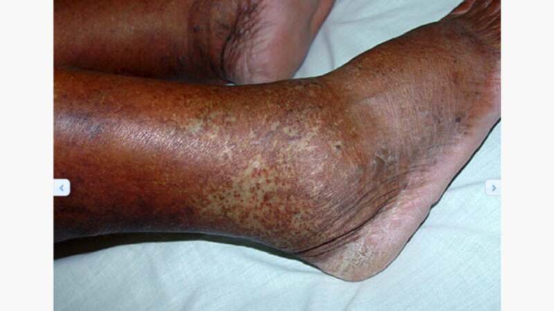Multiple Myeloma Rash Pictures: Types, Symptoms, and More