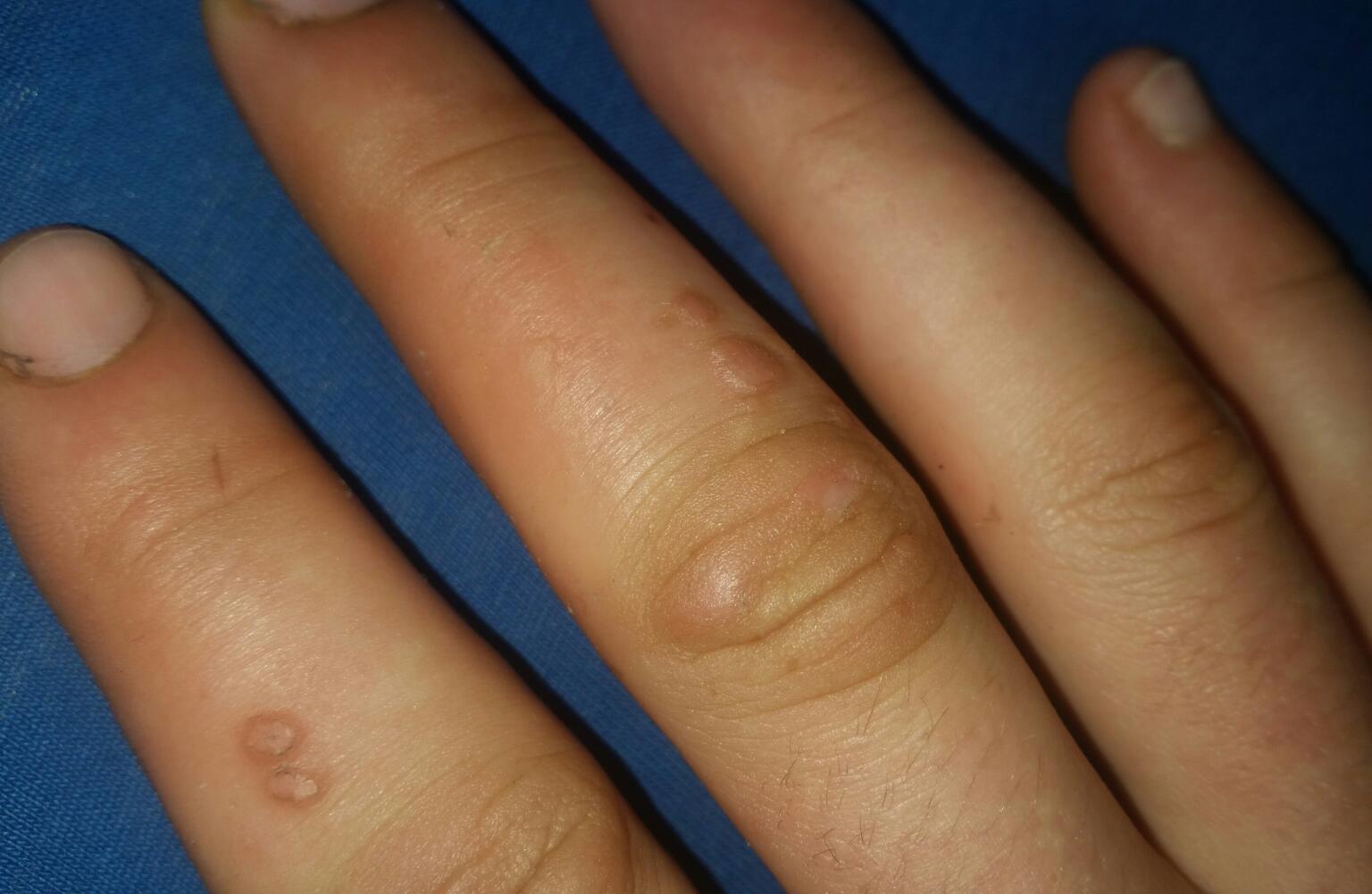 Warts: Types, Causes, Symptoms, Treatments & Removal - Healthgrades