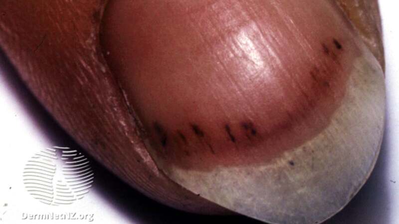 Psoriatic Arthritis Nails: Symptoms, Treatment, and More