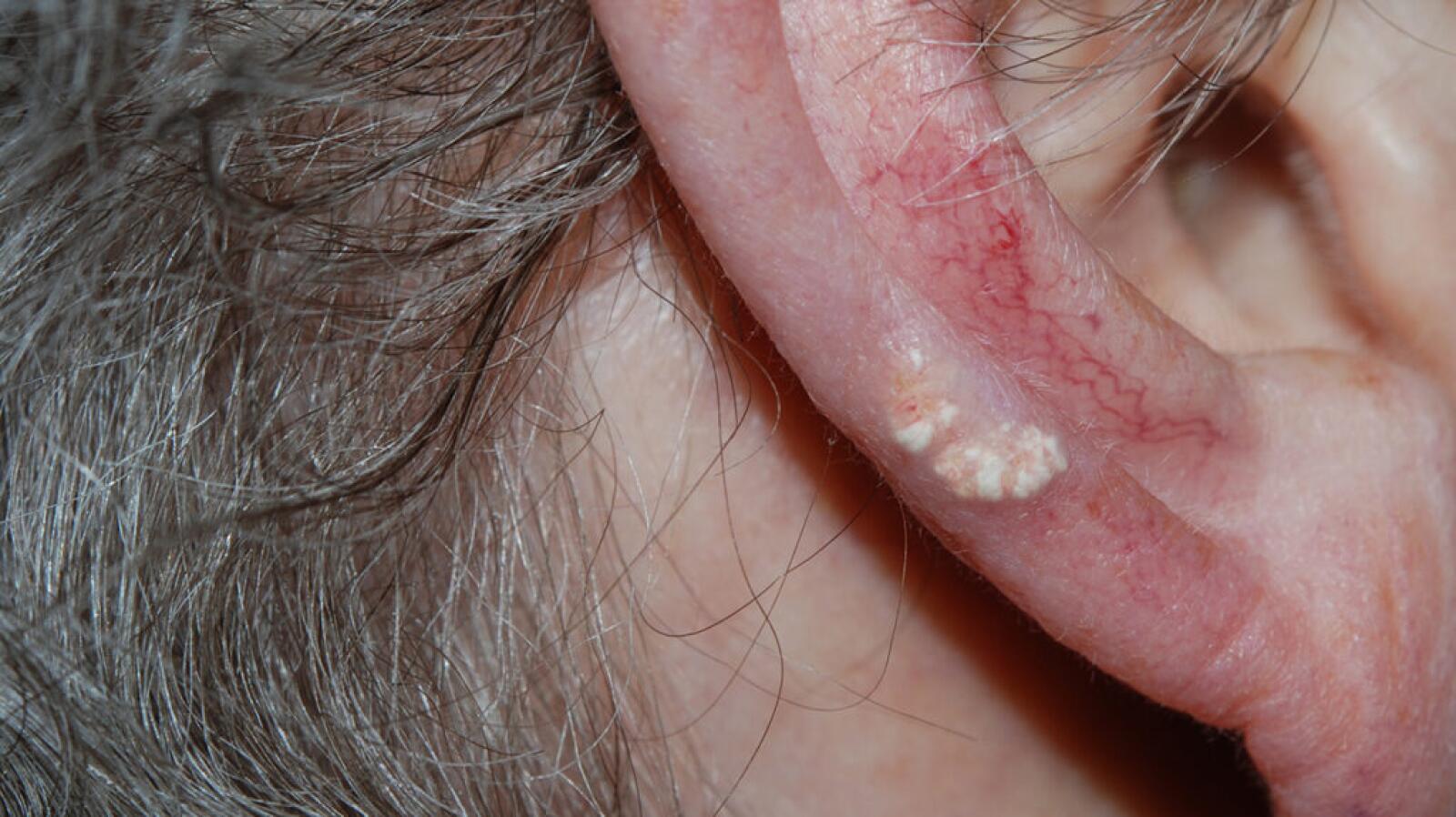 Pilomatricoma: Signs, Causes, and Treatment