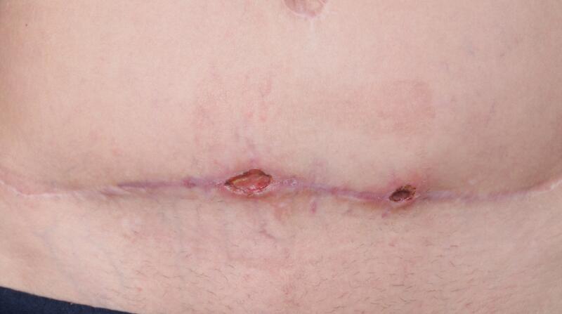 cellulitis nos