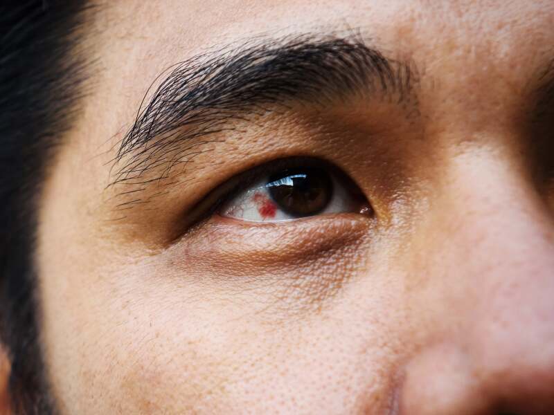 Subconjunctival Hemorrhage: Symptoms, Causes, Treatments