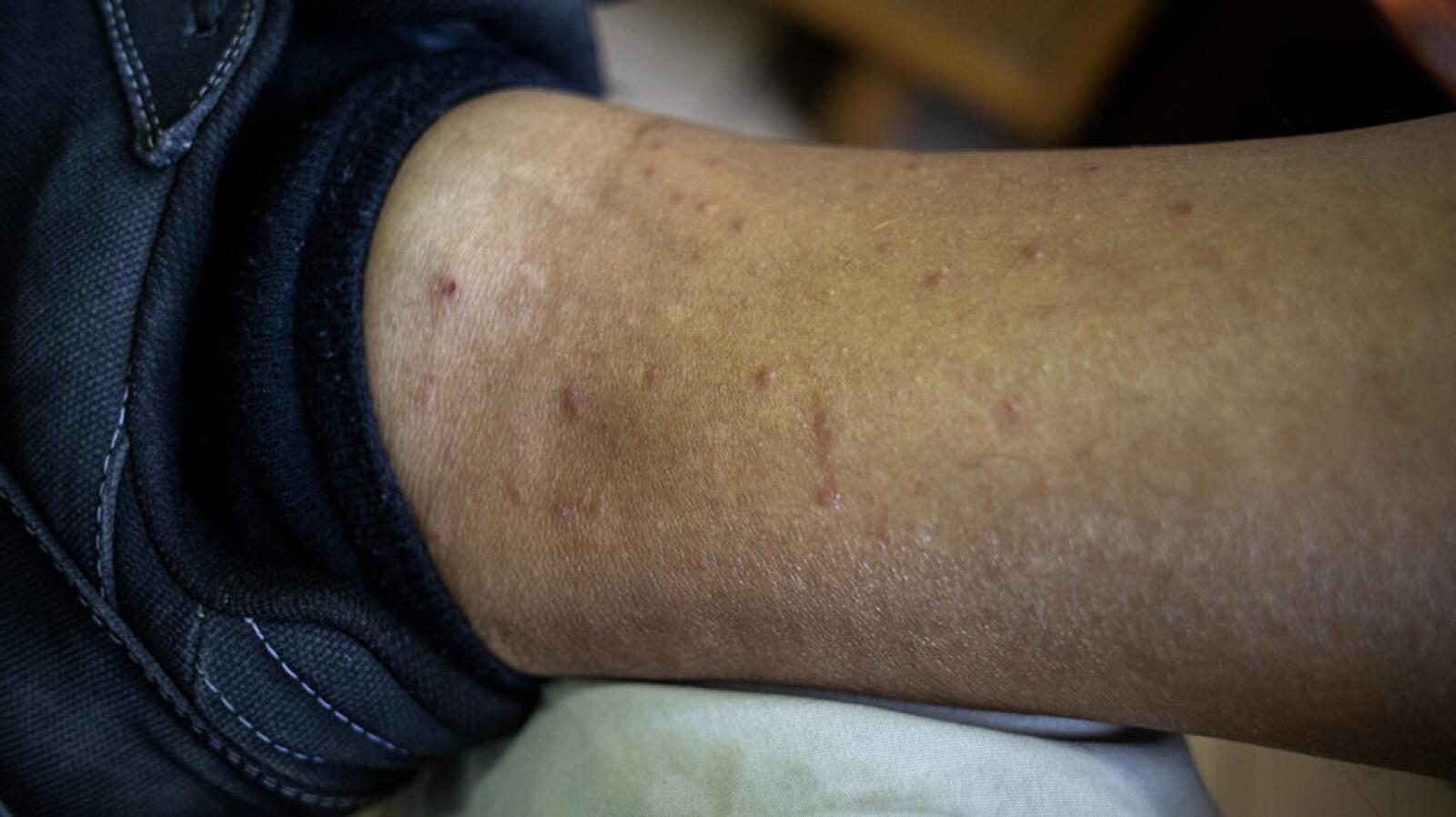 Bug Bite Pictures: Symptoms, Identification, Treatment, and More