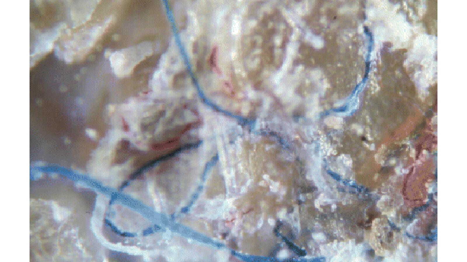 Morgellons: Definition, Symptoms, Treatments