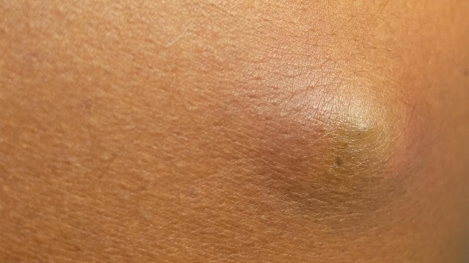Epidermoid Cysts Causes Treatments And More